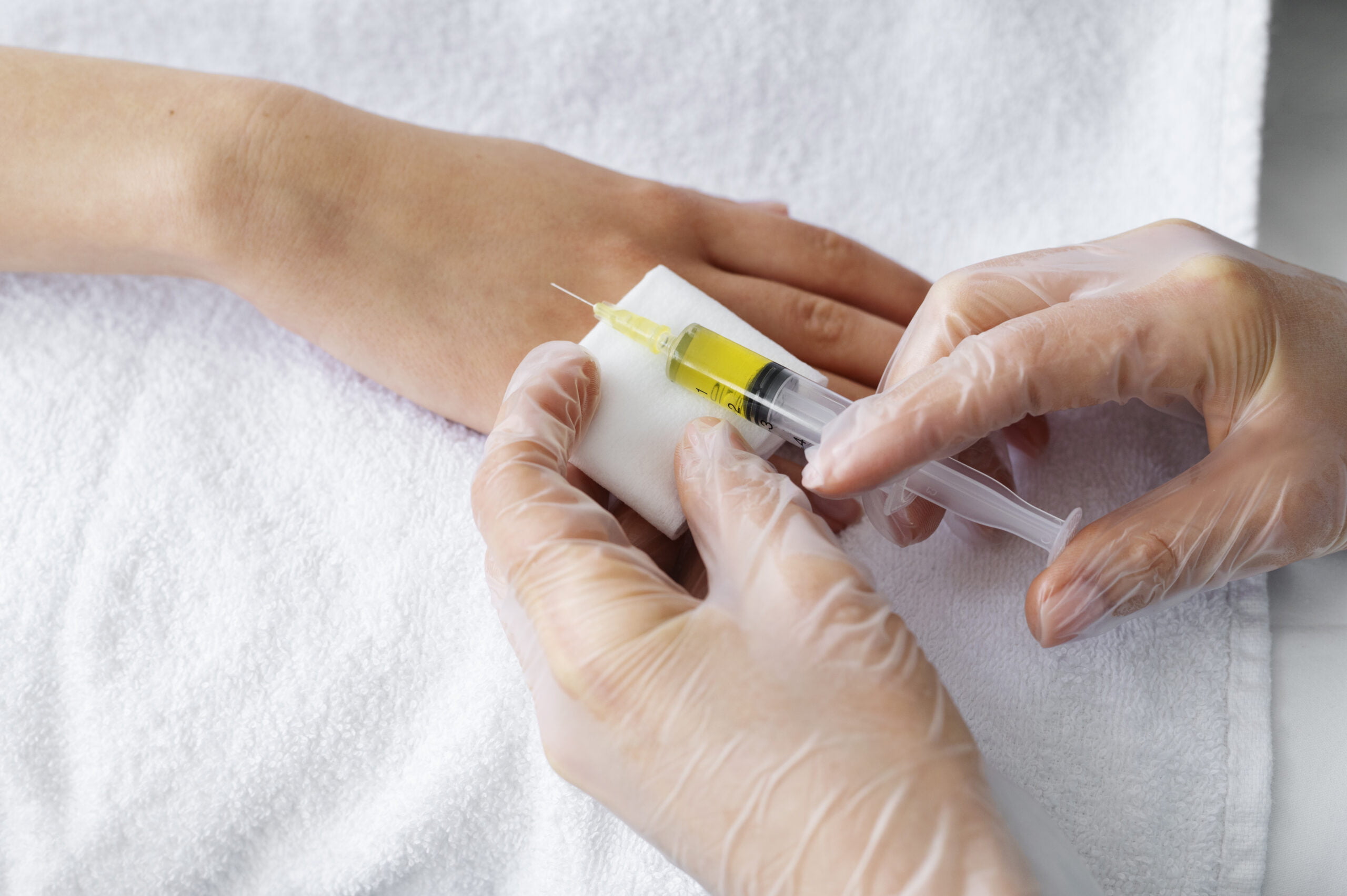 Platelet Rich Plasma Hands | Galan Aesthetics